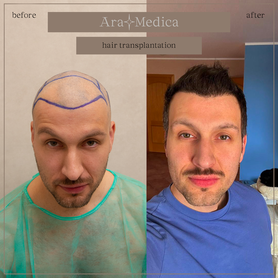 Trapianto Capelli – AraMedica Istanbul Clinica